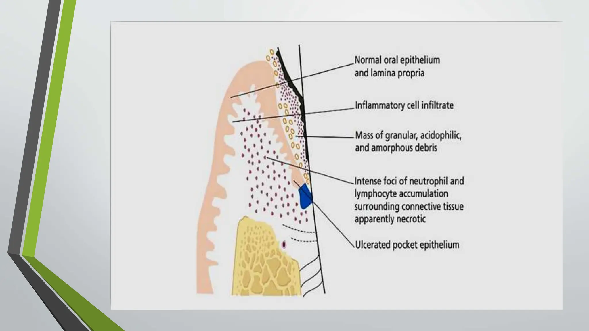 Acute Necrotizing Ulcerative Gingivitis.pptx