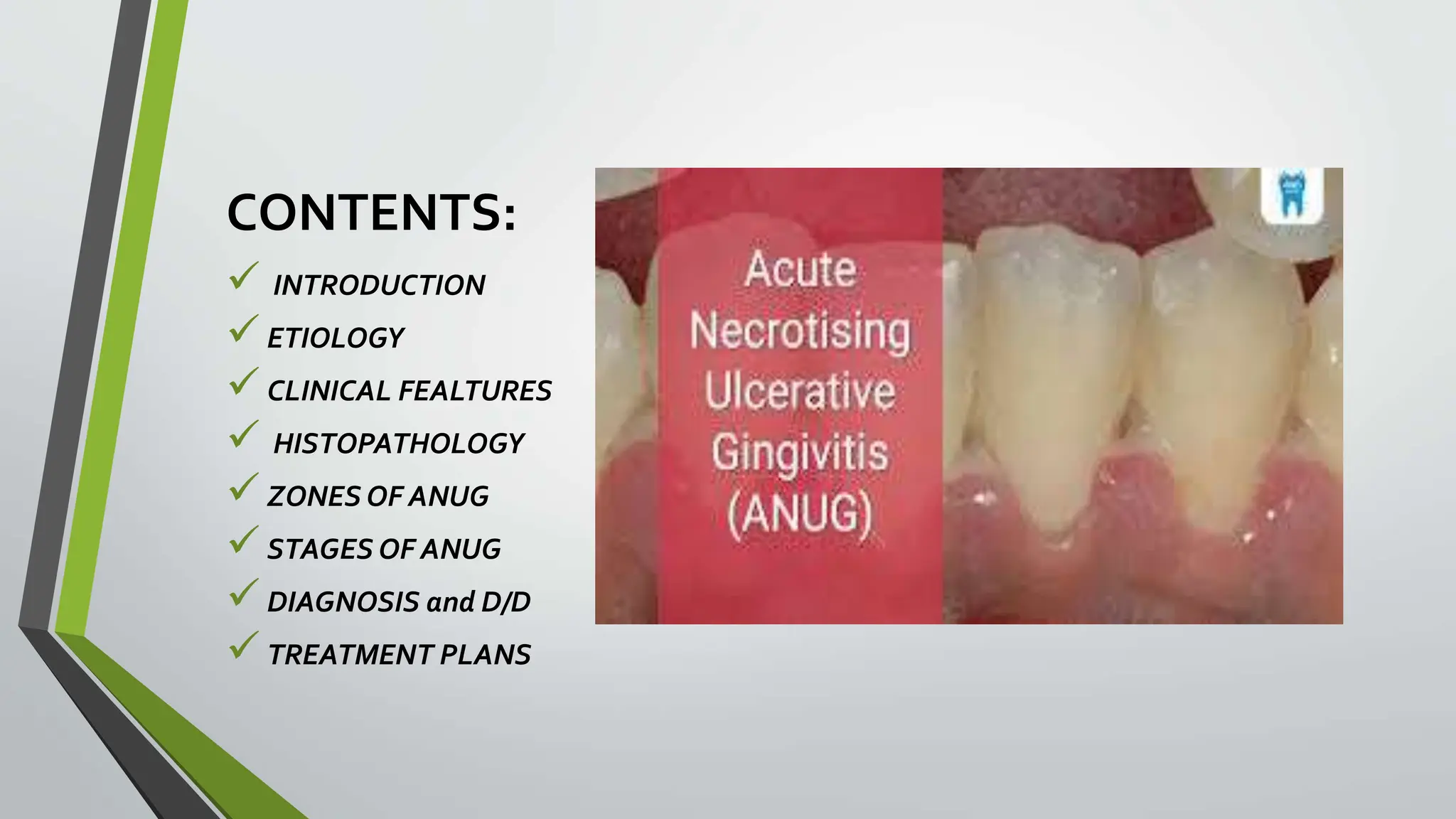 Acute Necrotizing Ulcerative Gingivitis.pptx