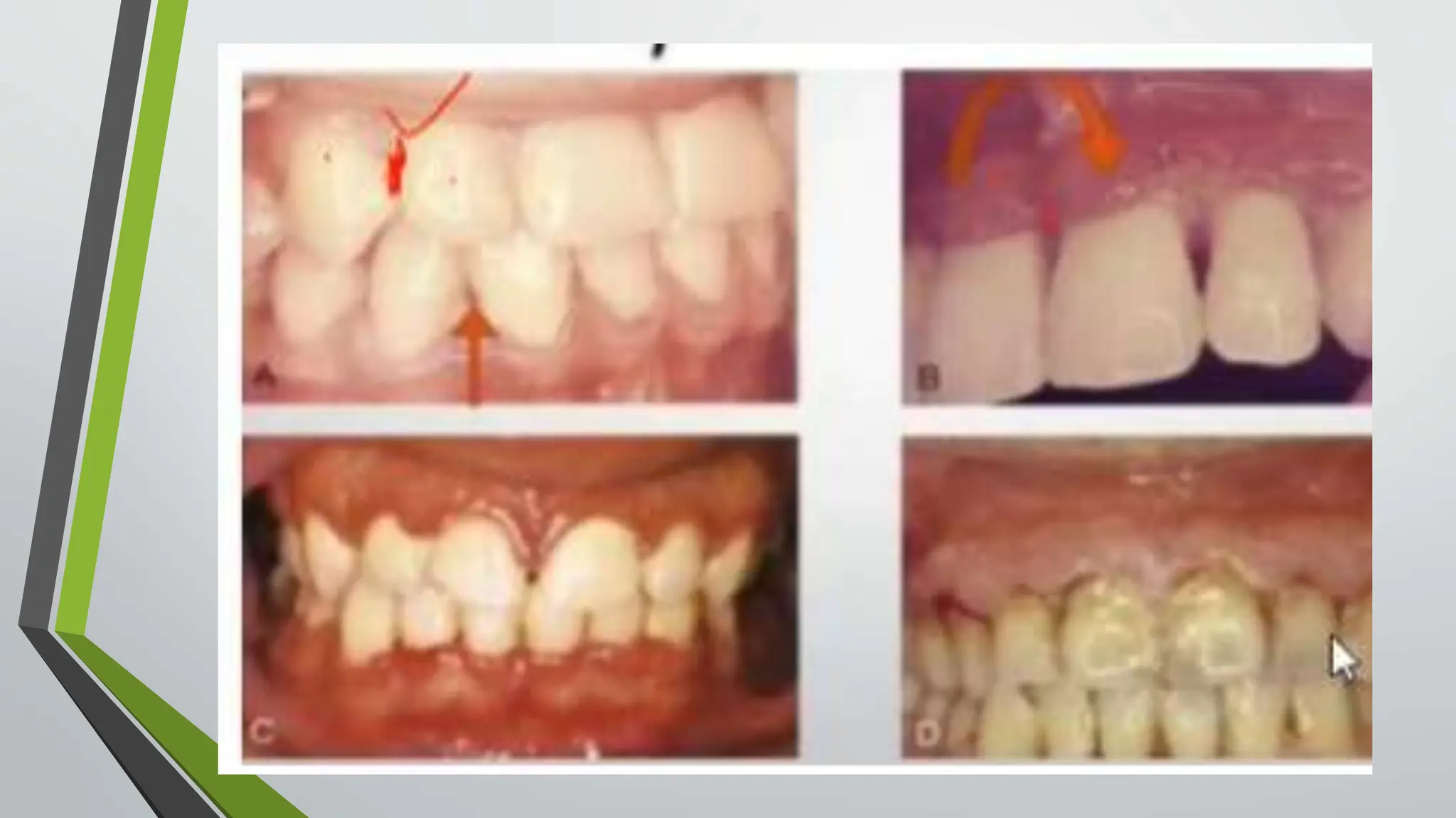 Acute Necrotizing Ulcerative Gingivitis.pptx