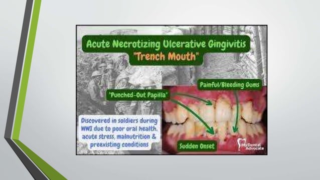 Acute Necrotizing Ulcerative Gingivitis.pptx | Dental Health | Diseases ...