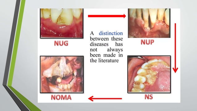 Acute Necrotizing Ulcerative Gingivitis.pptx | Dental Health | Diseases ...