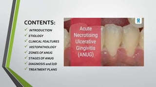 Acute Necrotizing Ulcerative Gingivitis.pptx