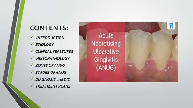 Acute Necrotizing Ulcerative Gingivitis.pptx | Dental Health | Diseases ...