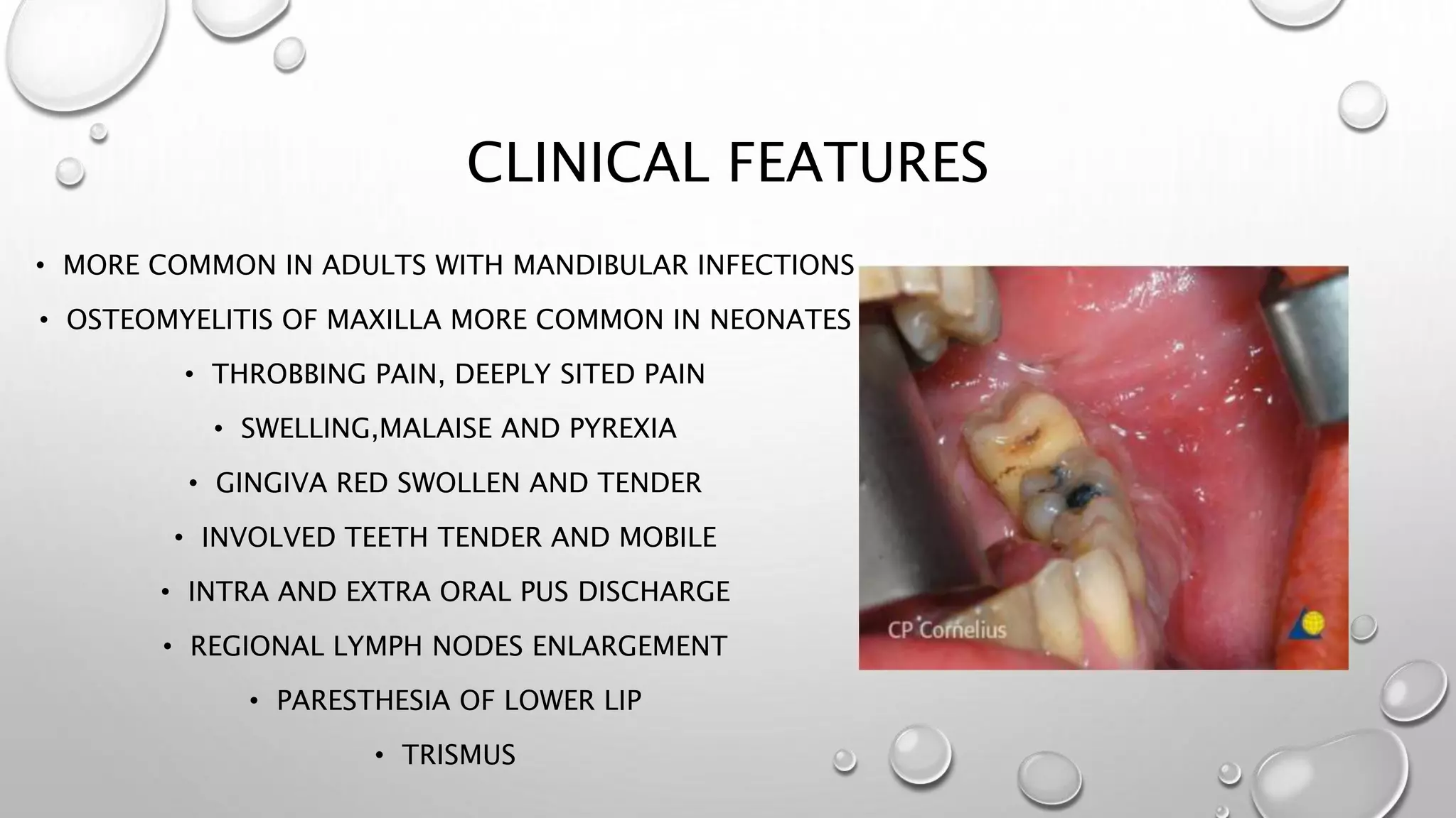Acute osteomyelitis | PPTX