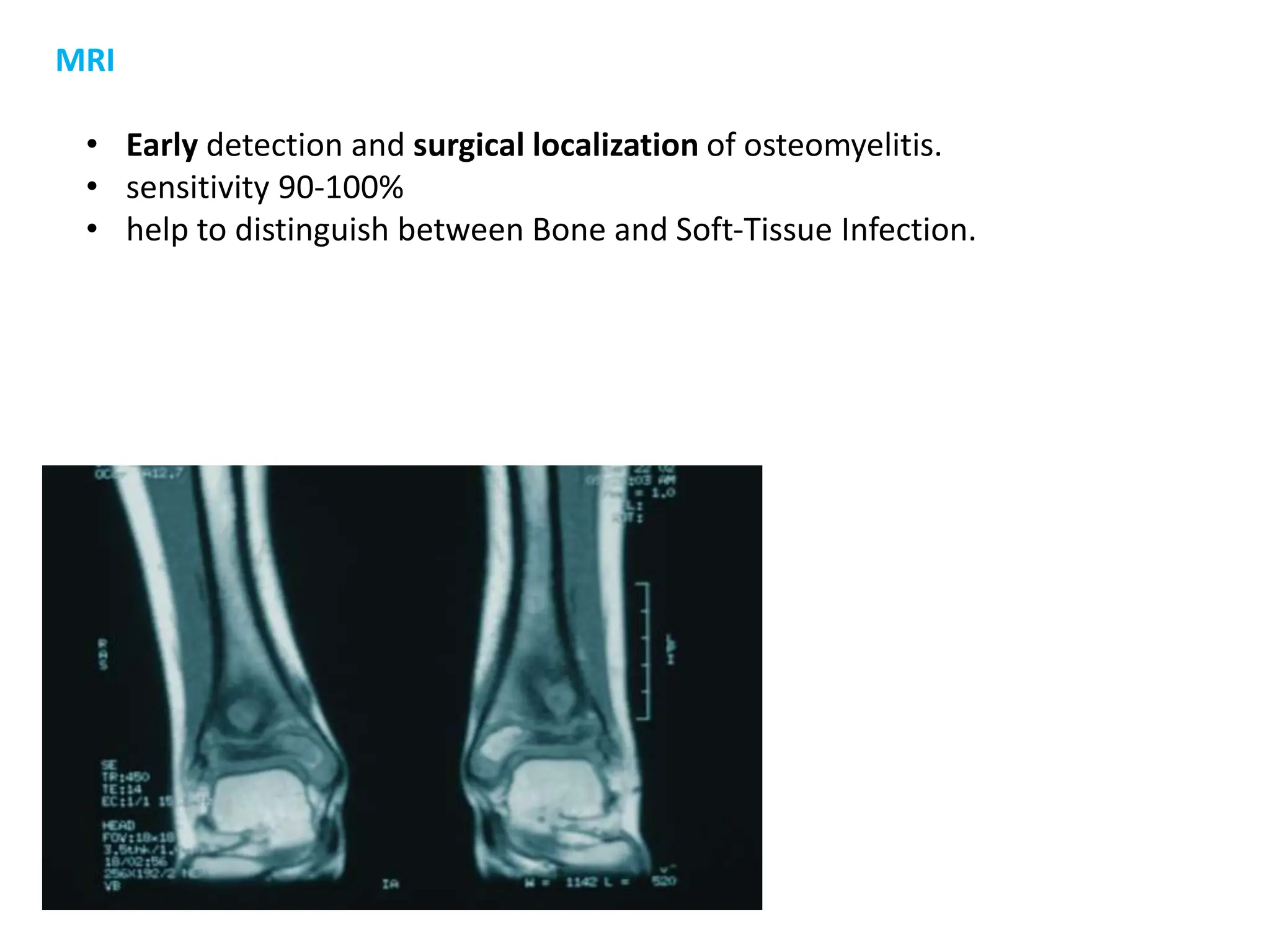 Orthopedic Lecture on Acute OsteoMyelitis | PPTX