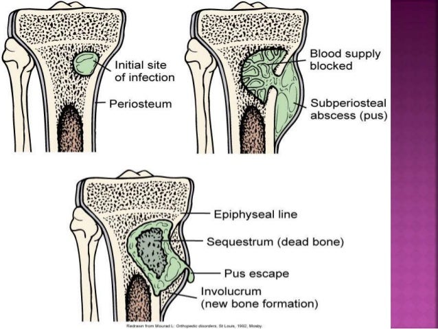 Acute osteomyelitis