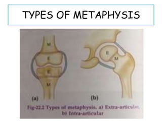 Acute osteomyelitis | PPTX