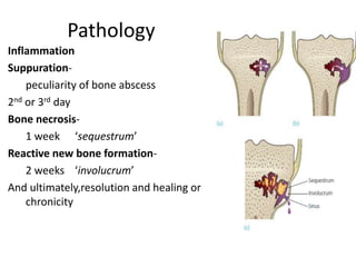 Acute osteomyelitis | PPTX