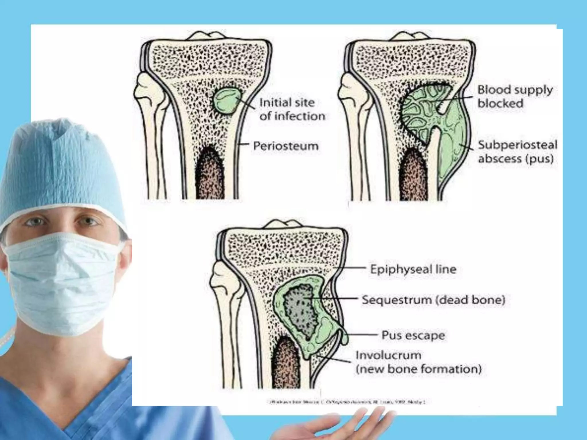 Acute osteomyelitis | PPT