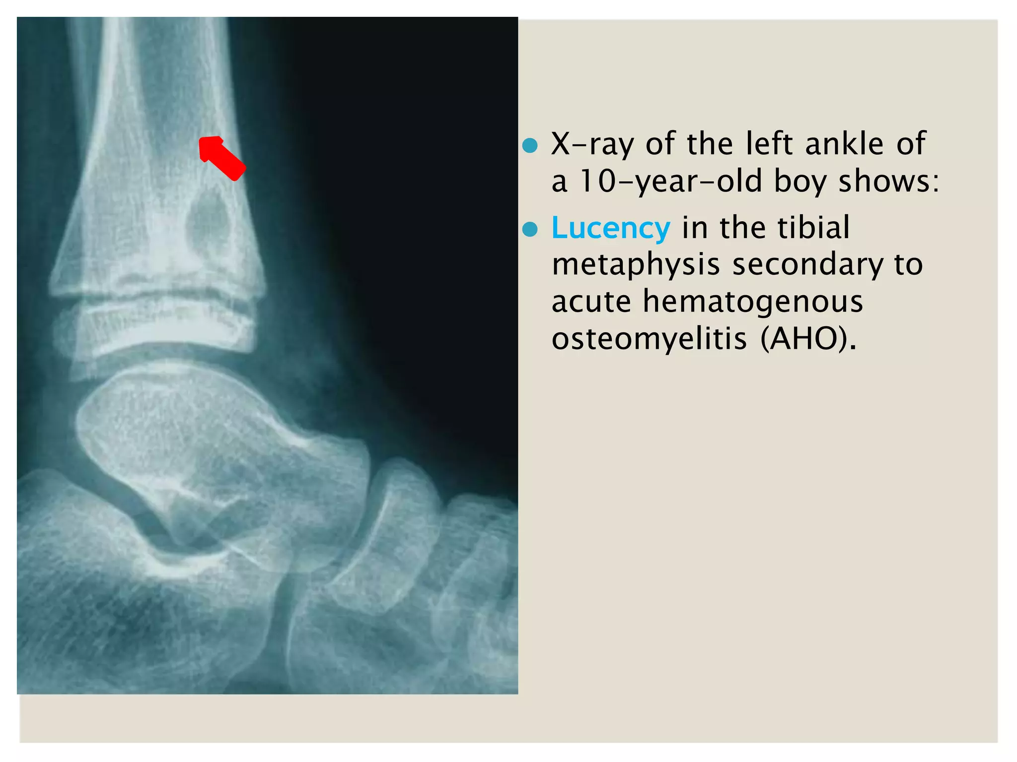 acuteosteomyelitis-.pptx