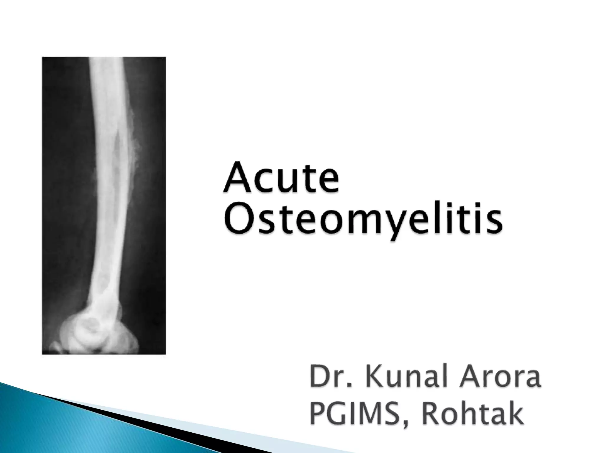 Acute osteomyelitis | PPTX
