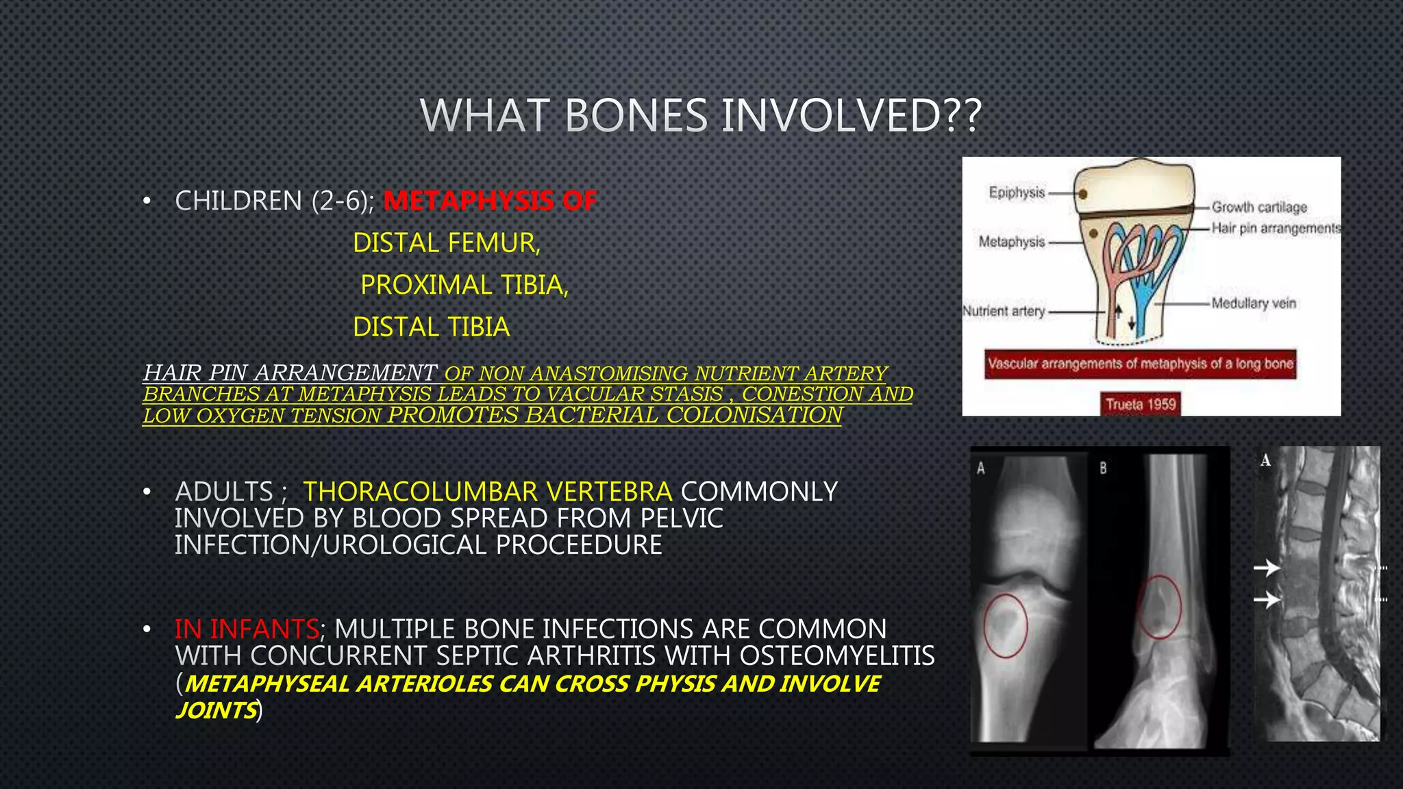 Acute osteomyelitis | PPTX