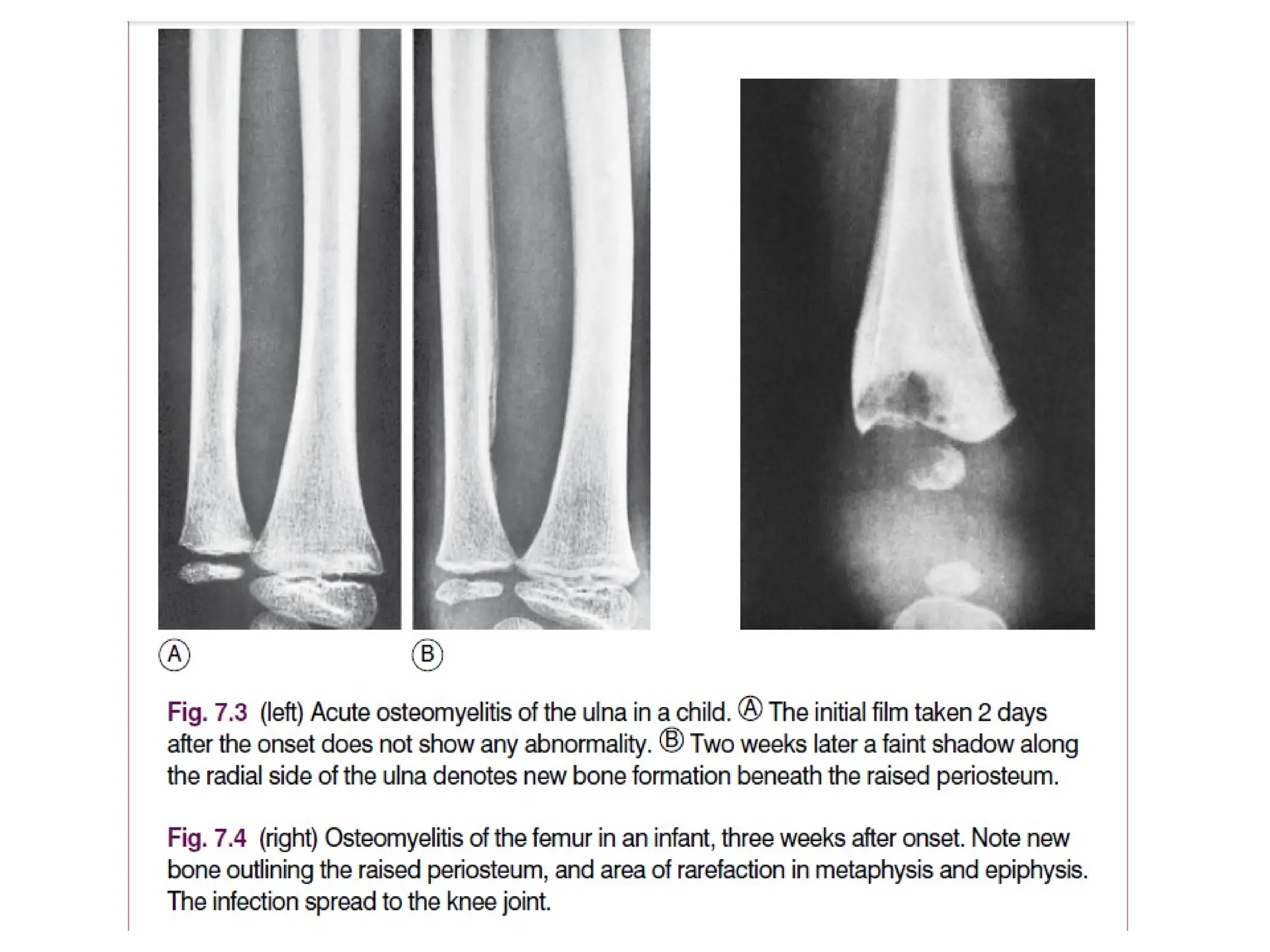 acute osteomyelitis. Treatment diagnosis and management | PPT