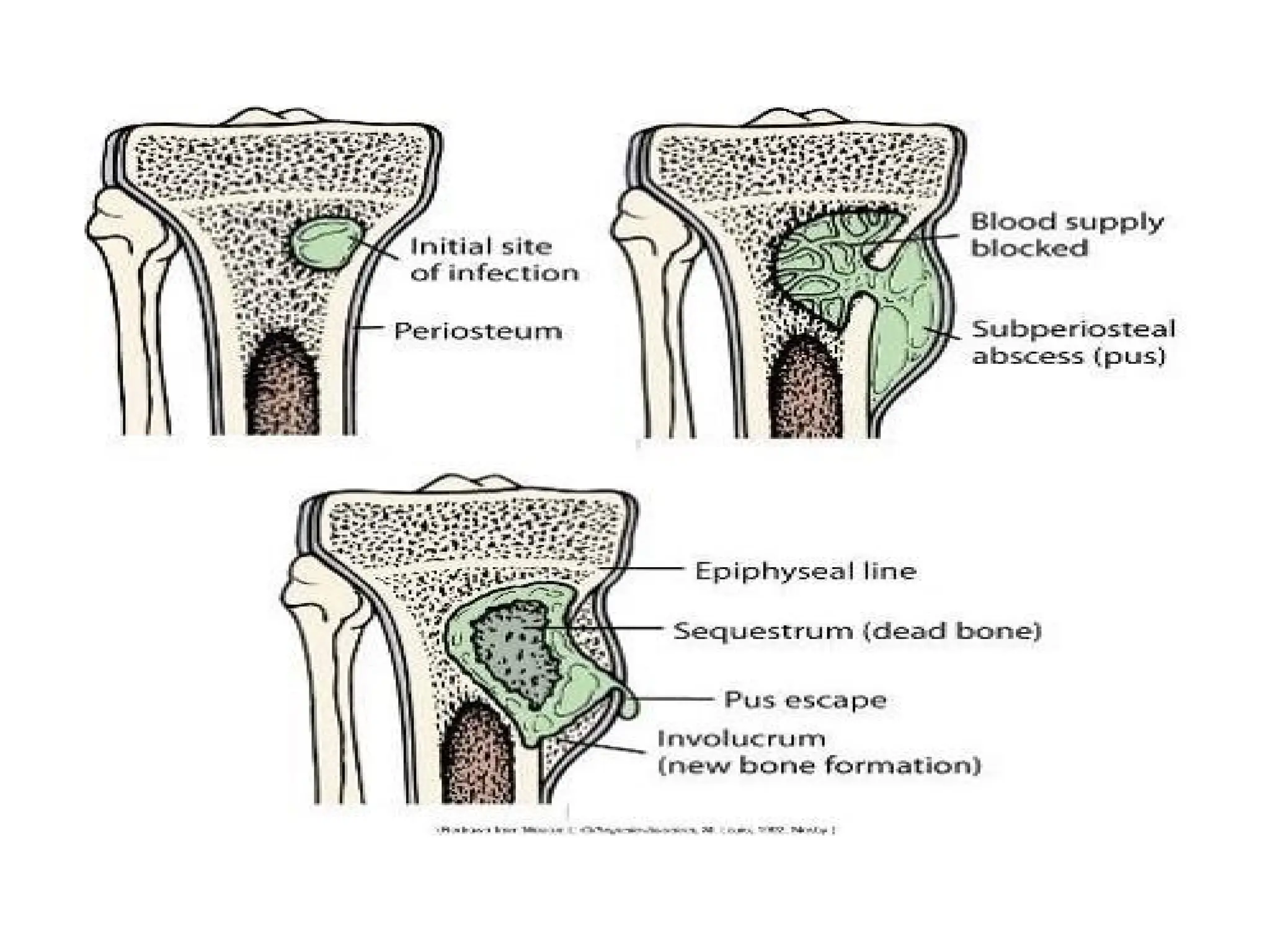 acute osteomyelitis. Treatment diagnosis and management | PPT