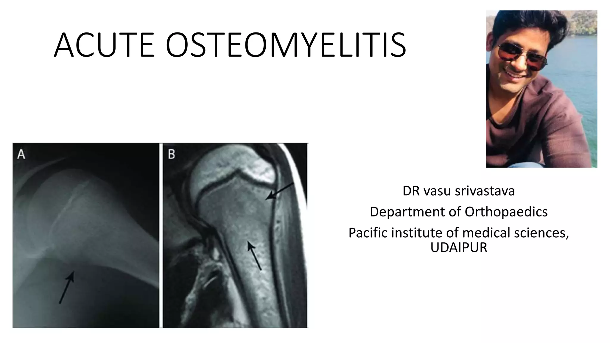 ACUTE OSTEOMYELITIS PPT.pptx