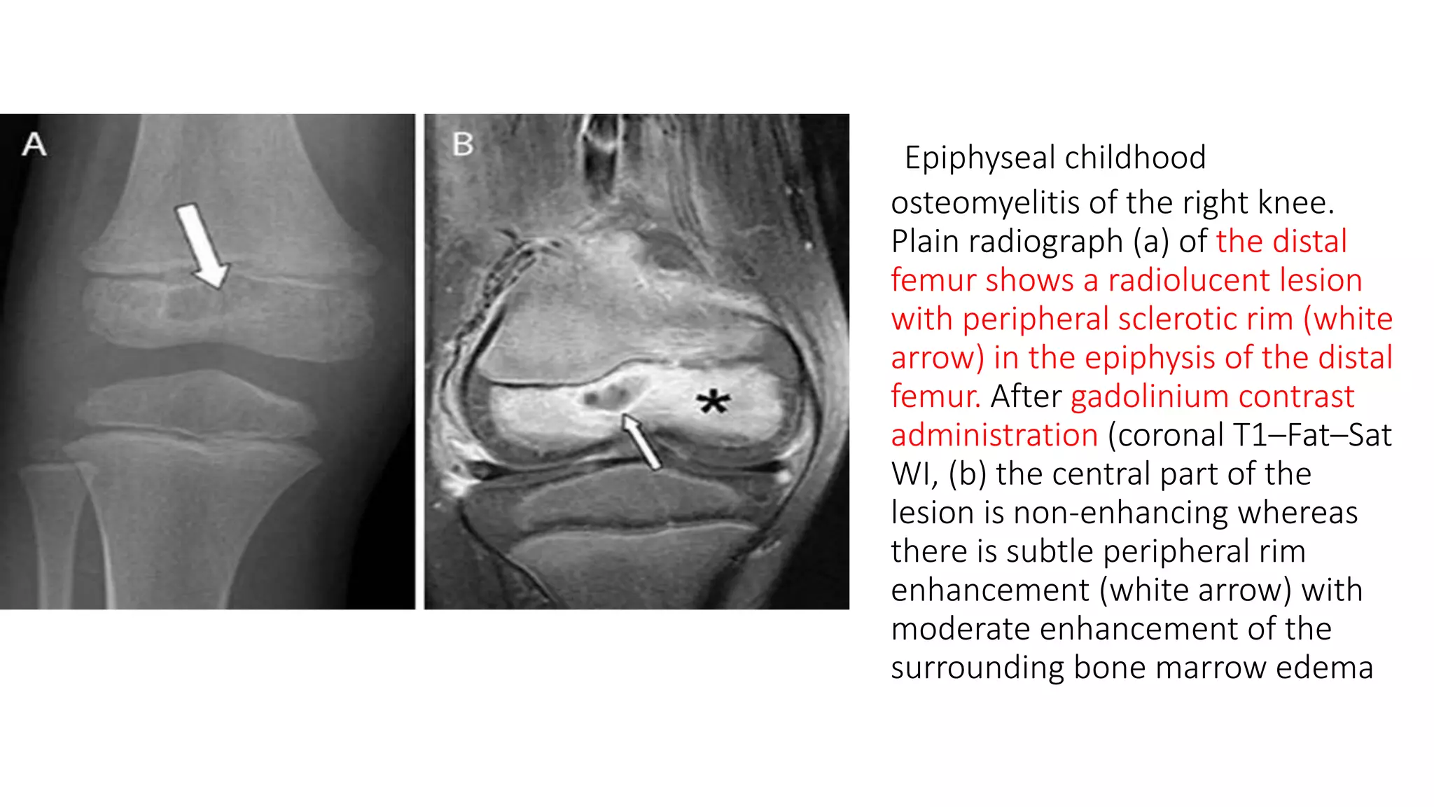 ACUTE OSTEOMYELITIS PPT.pptx