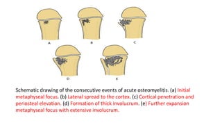 ACUTE OSTEOMYELITIS PPT.pptx