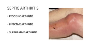 ACUTE OSTEOMYELITIS SEPTIC ARTHRITIS AND TOM SMITH ARTHRITIS.pptx