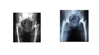ACUTE OSTEOMYELITIS SEPTIC ARTHRITIS AND TOM SMITH ARTHRITIS.pptx