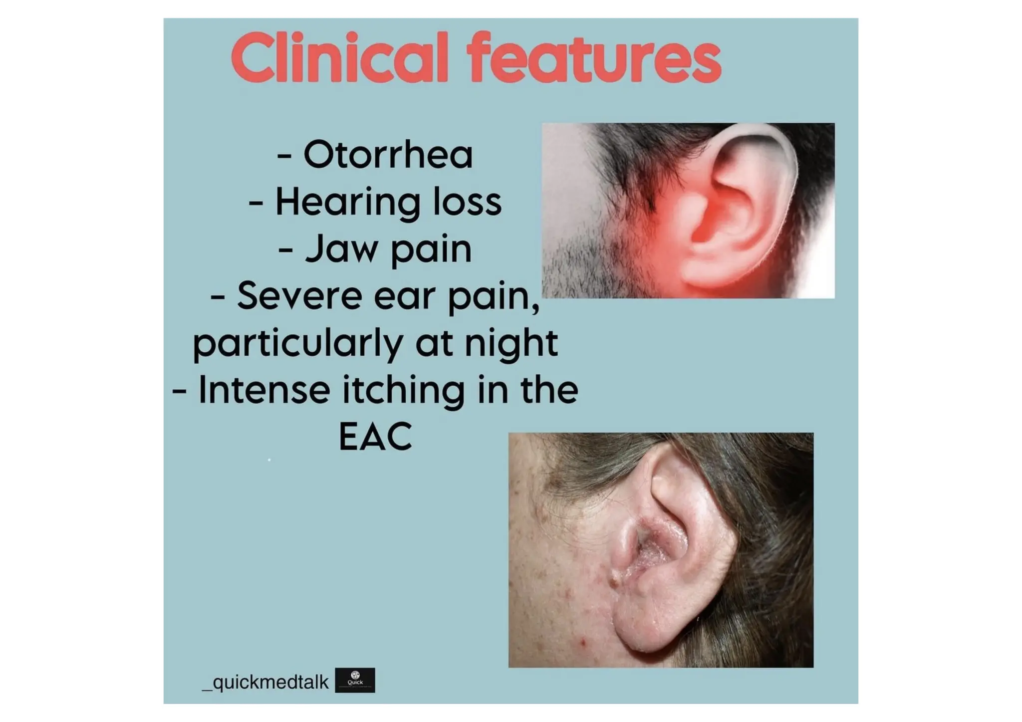 Acute otitis externa.pdf ENT BY QUICKMEDTALK | PDF