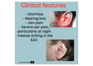 Acute otitis externa.pdf ENT BY QUICKMEDTALK | PDF