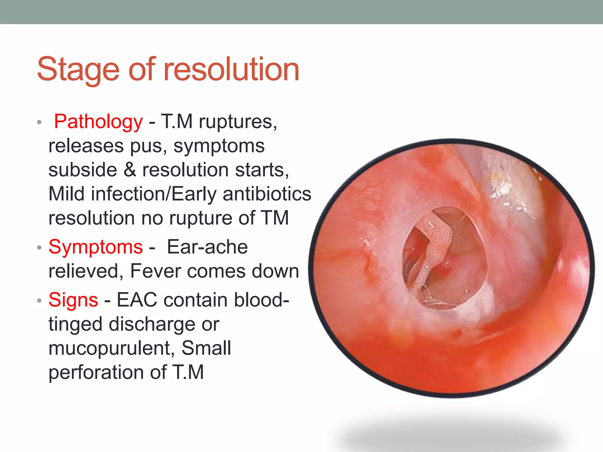 Acute otitis media | PPTX