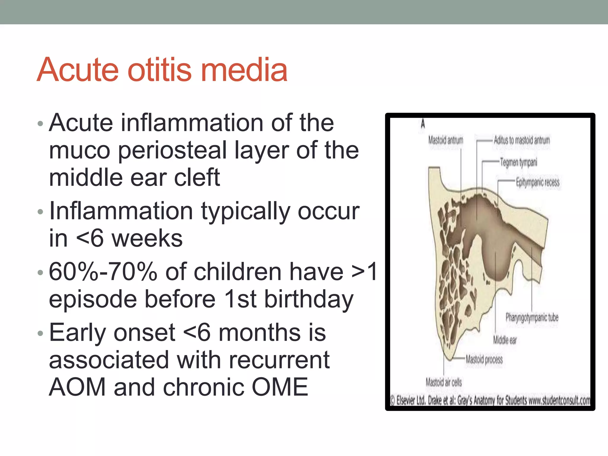 Acute otitis media | PPTX
