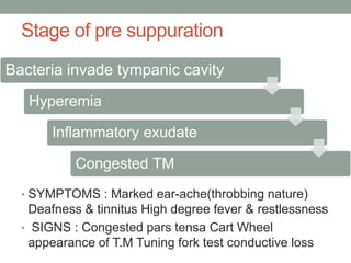 Acute otitis media | PPTX