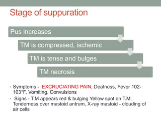 Acute otitis media | PPTX