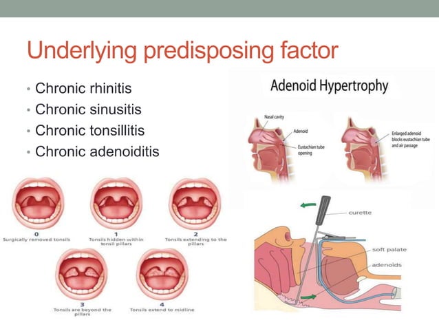 Acute otitis media | PPTX | Ear, Nose and Throat Conditions | Diseases ...