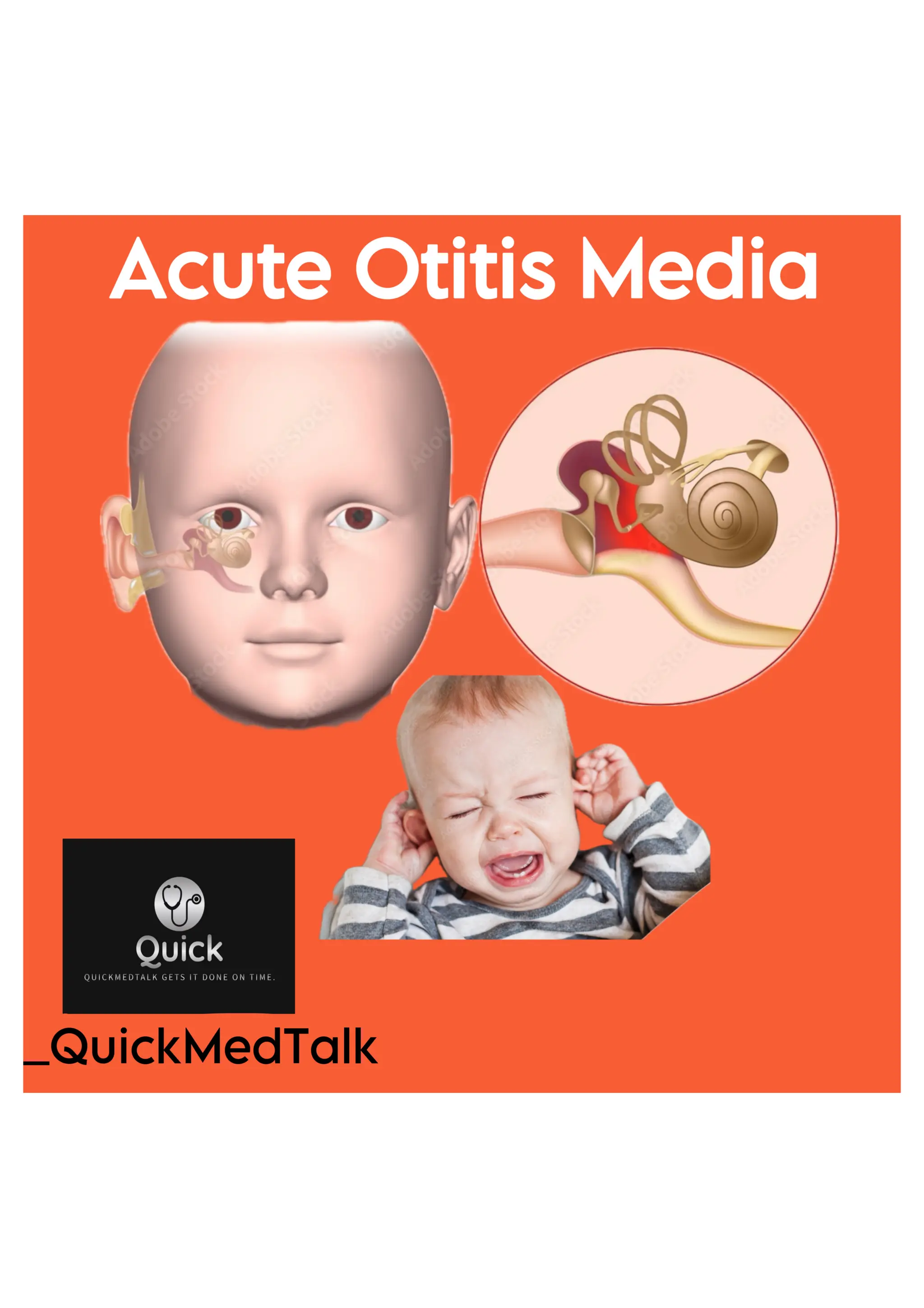 Acute otitis media .pdf ENT BY QUICKMEDTALK | PDF