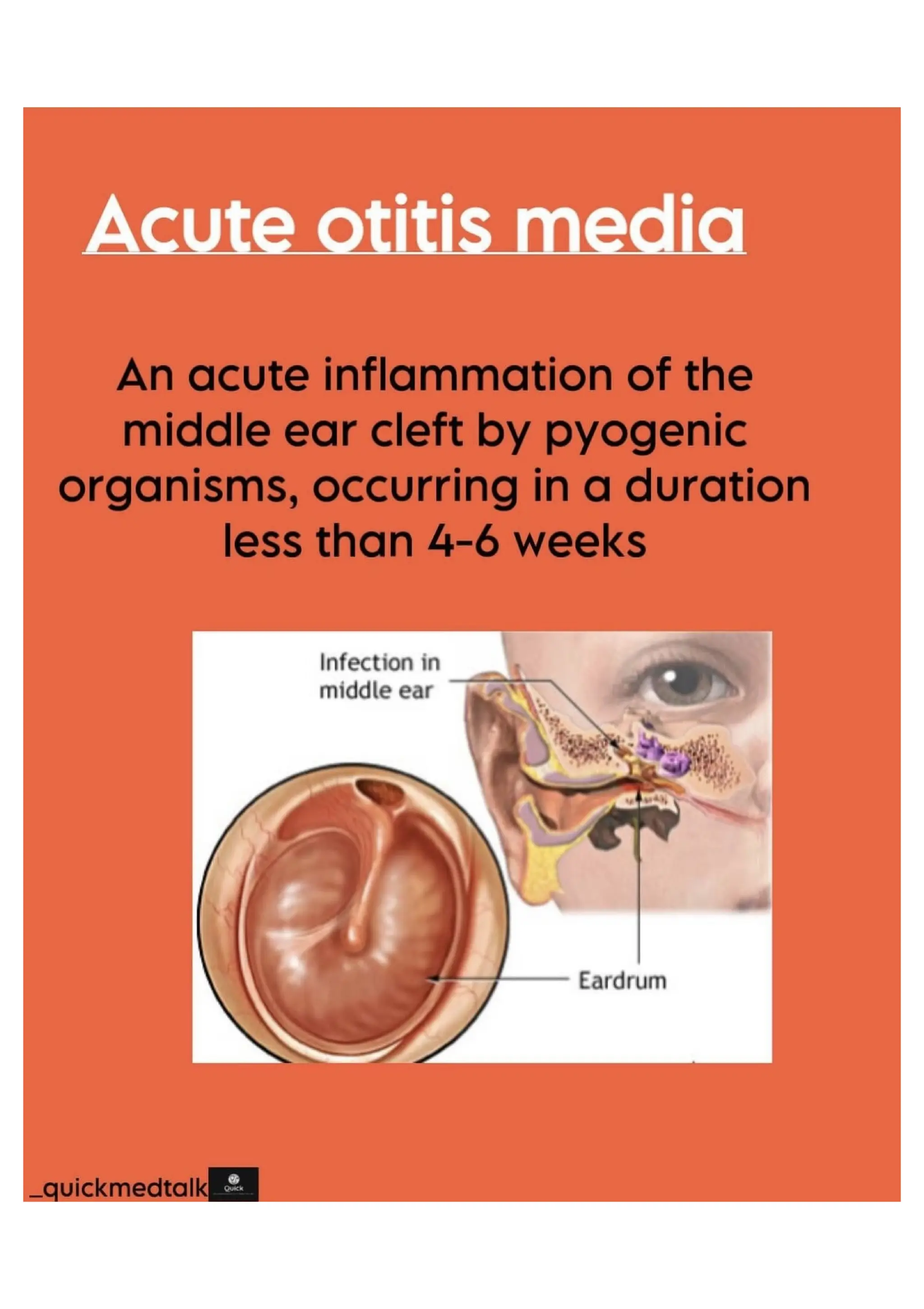 Acute otitis media .pdf ENT BY QUICKMEDTALK | PDF