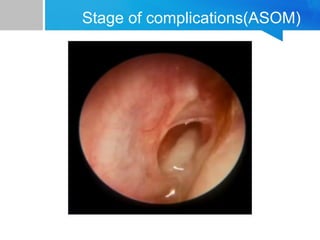 ACUTE OTITIS MEDIA presentation.pptx Introduction Definition Anatomy ...