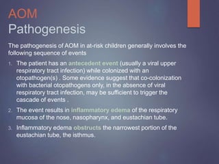 Acute otitis media | PPTX