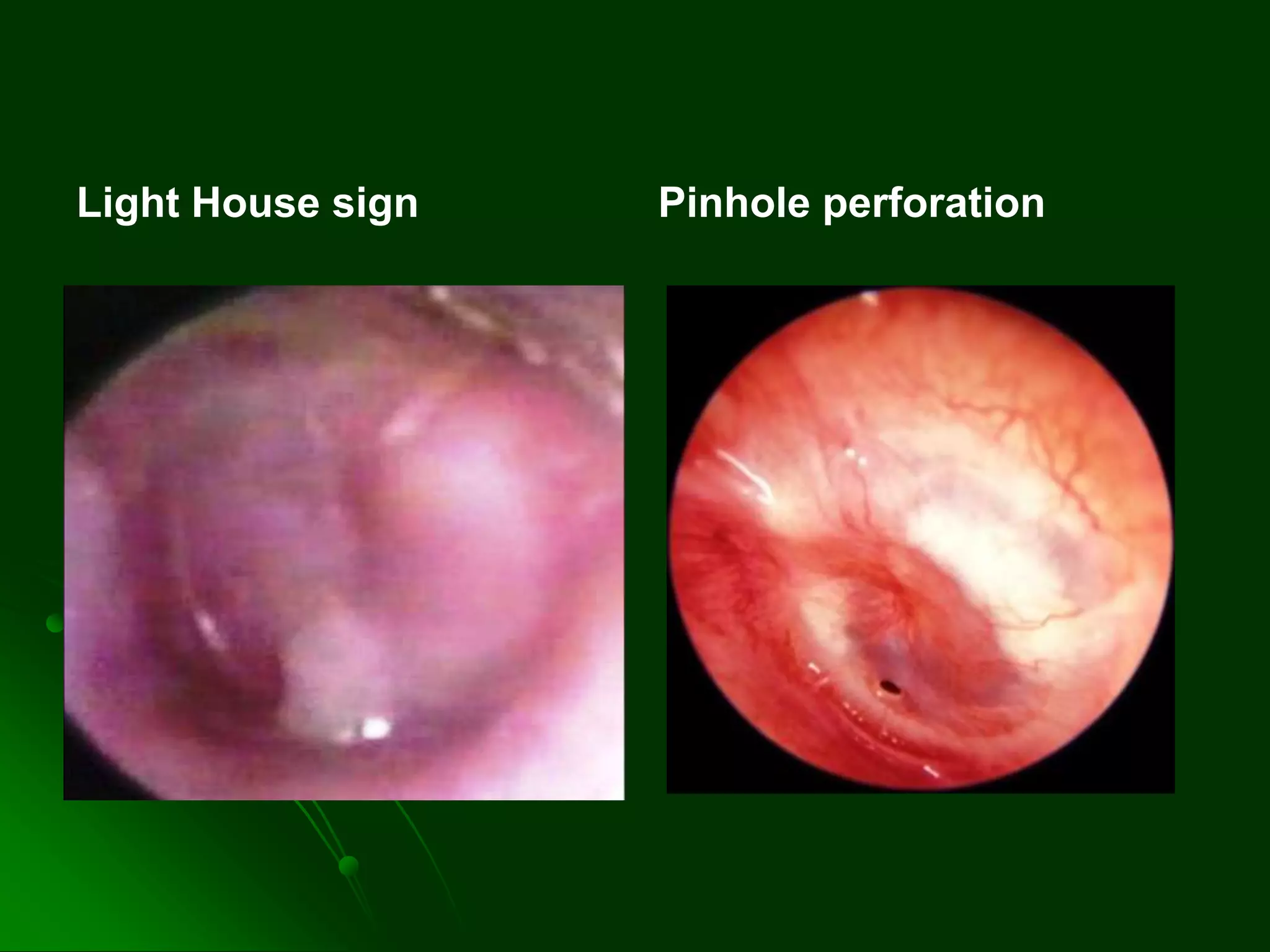 Acute Otitis Media and effusion.pptx
