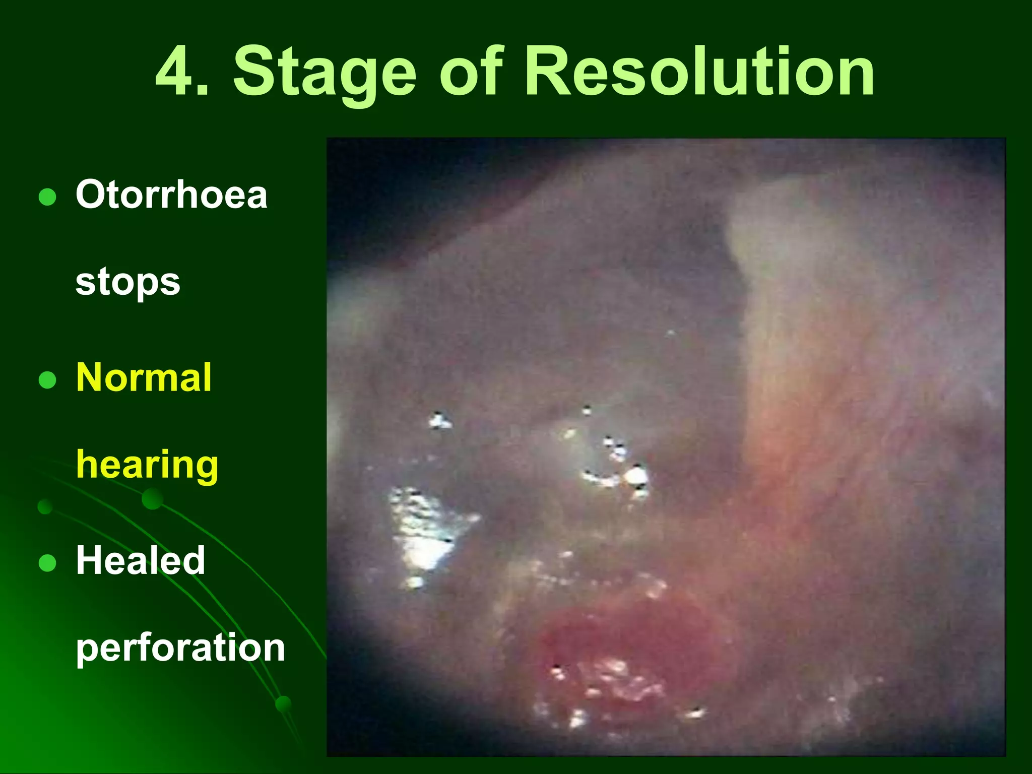 Acute Otitis Media and effusion.pptx