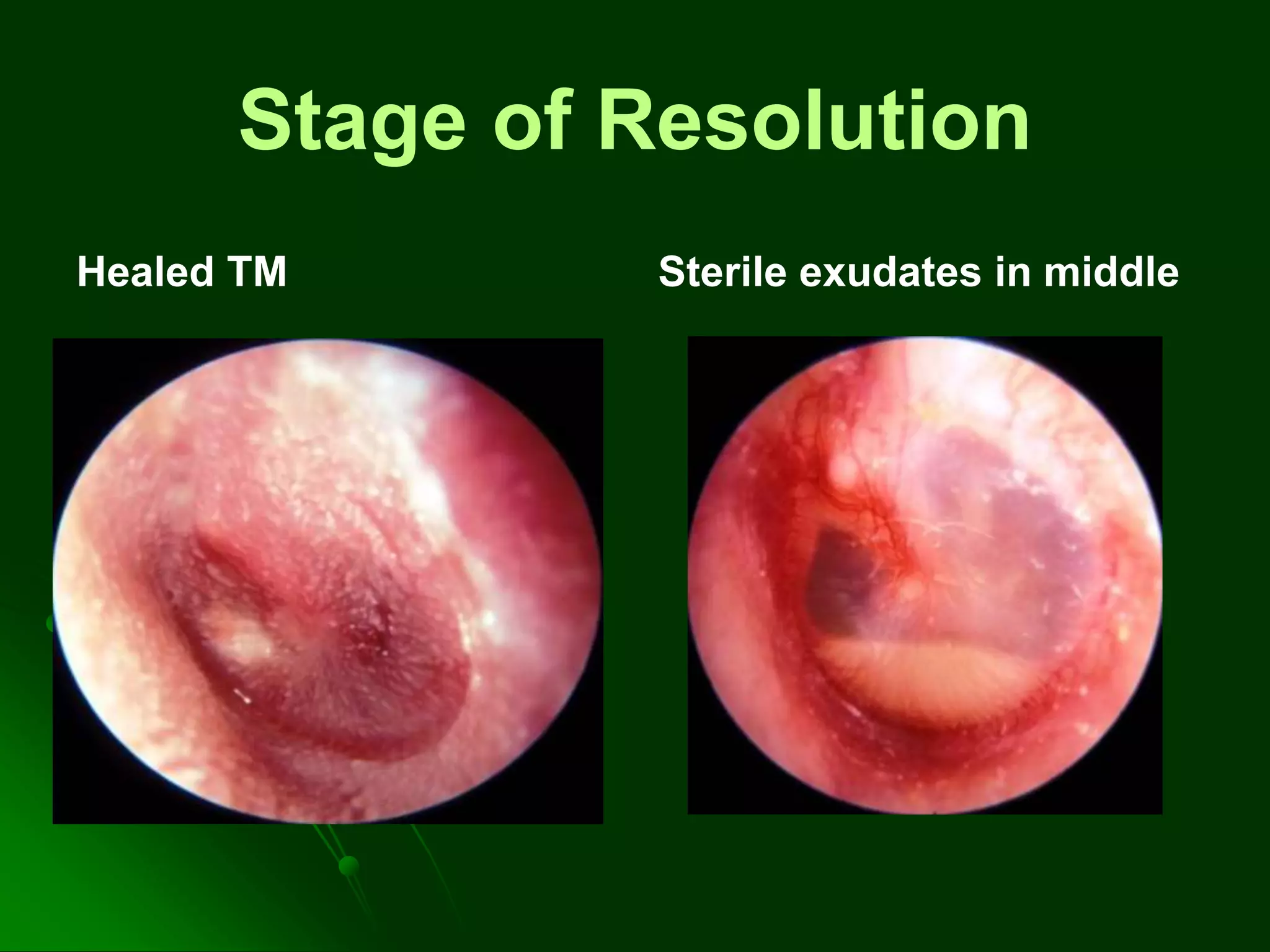 Acute Otitis Media and effusion.pptx