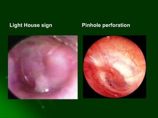Acute Otitis Media and effusion.pptx