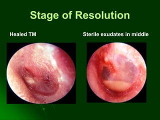 Acute Otitis Media and effusion.pptx