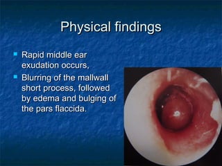 Acute otitis media and mastoiditis | PPT