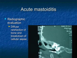 Acute otitis media and mastoiditis | PPT