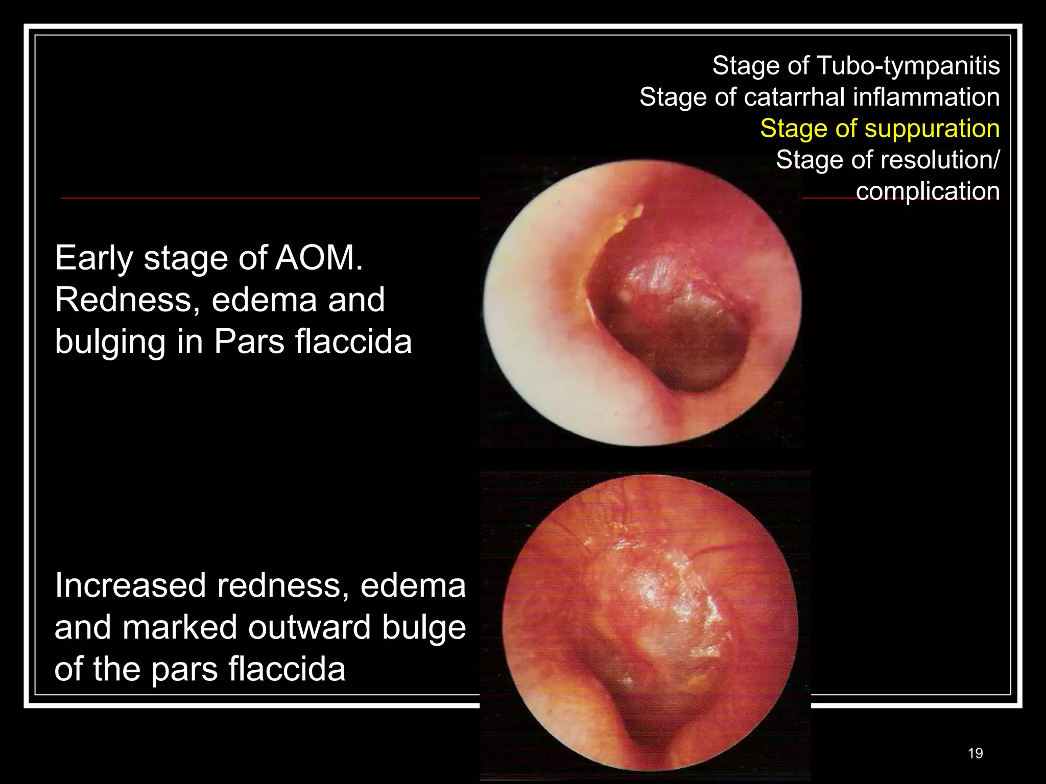 Acute otitis media (AOM) secretory otitis media (OME) | PPT
