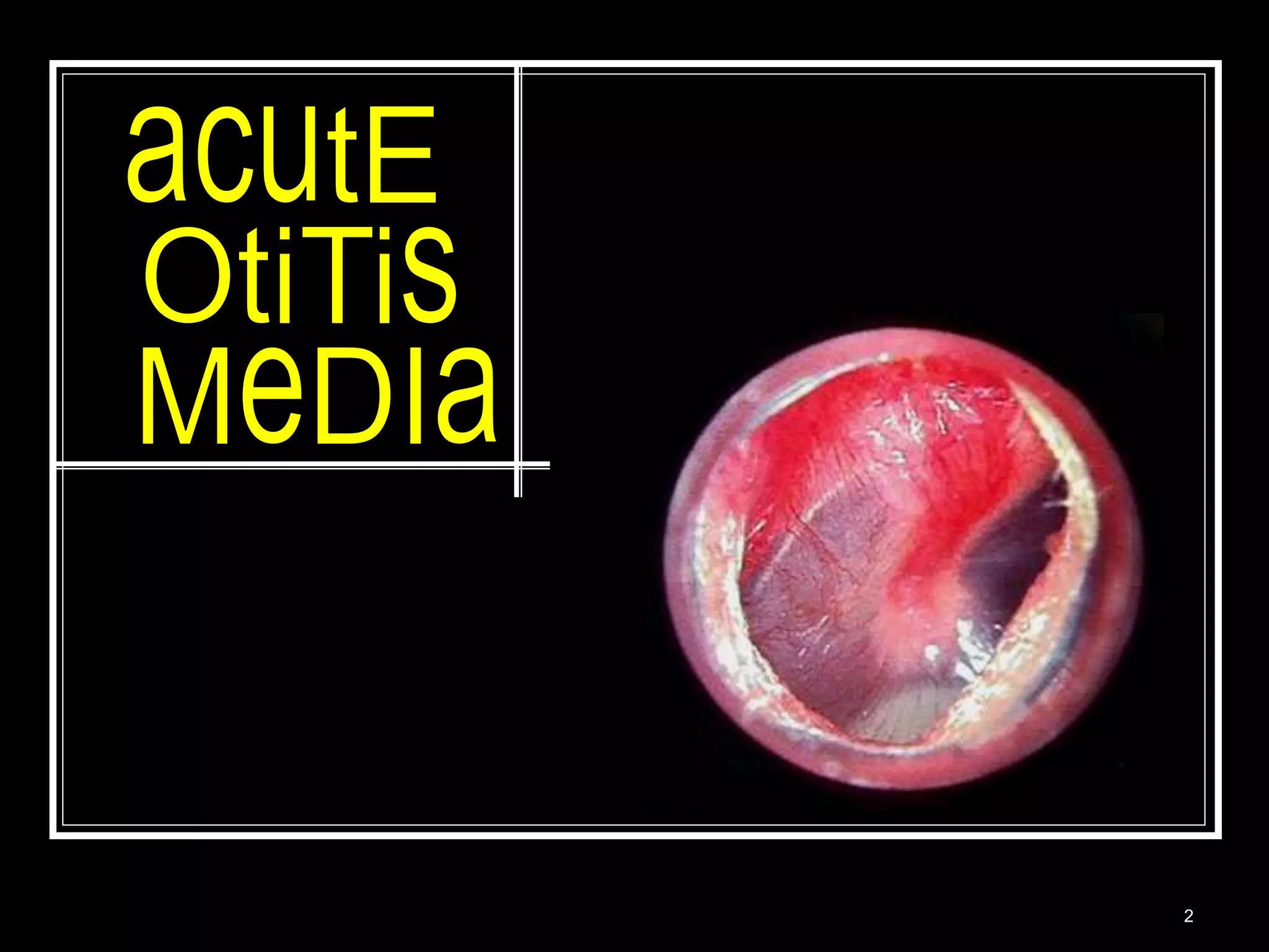 Acute otitis media (AOM) secretory otitis media (OME) | PPT