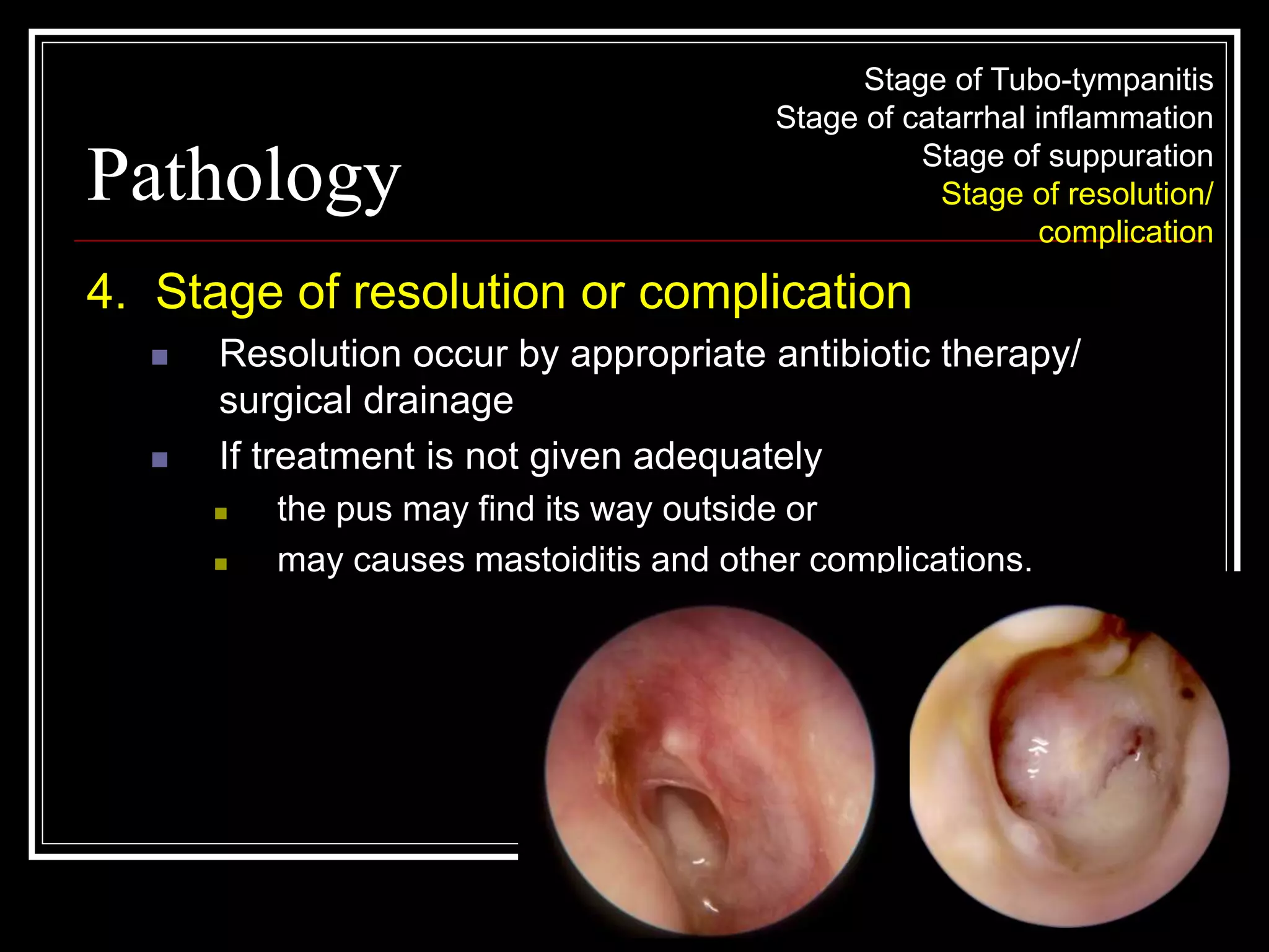 Acute otitis media (AOM) secretory otitis media (OME) | PPT