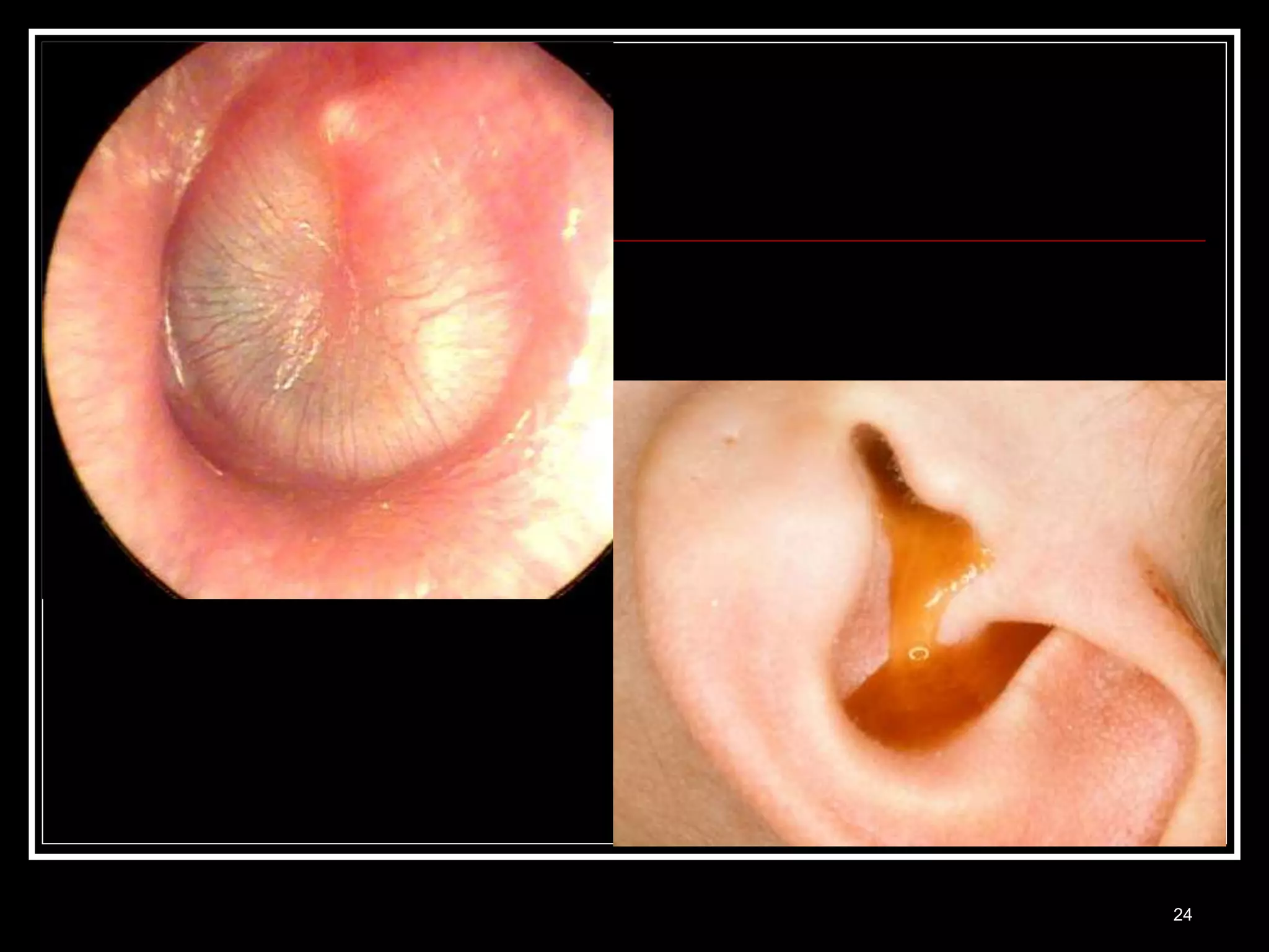 Acute otitis media (AOM) secretory otitis media (OME) | PPT | Ear, Nose ...