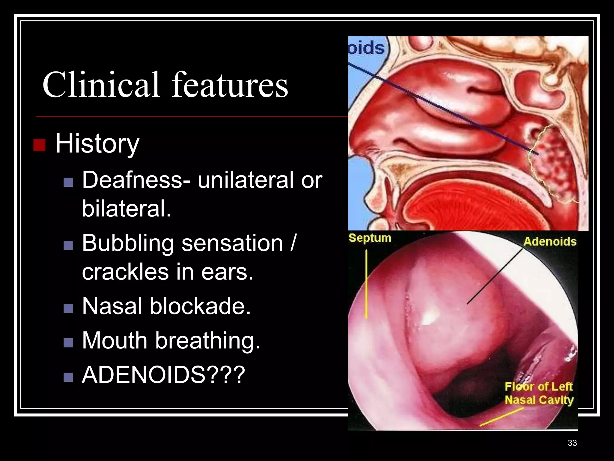 Acute otitis media (AOM) secretory otitis media (OME) | PPT | Ear, Nose ...