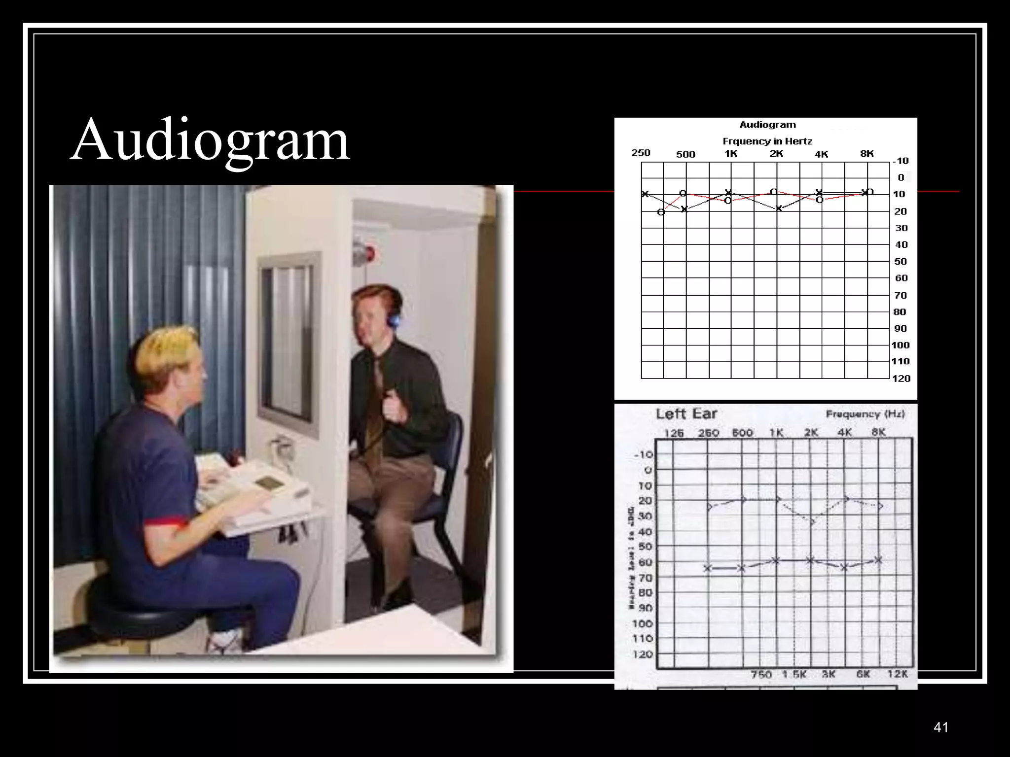 Acute otitis media (AOM) secretory otitis media (OME) | PPT | Ear, Nose ...