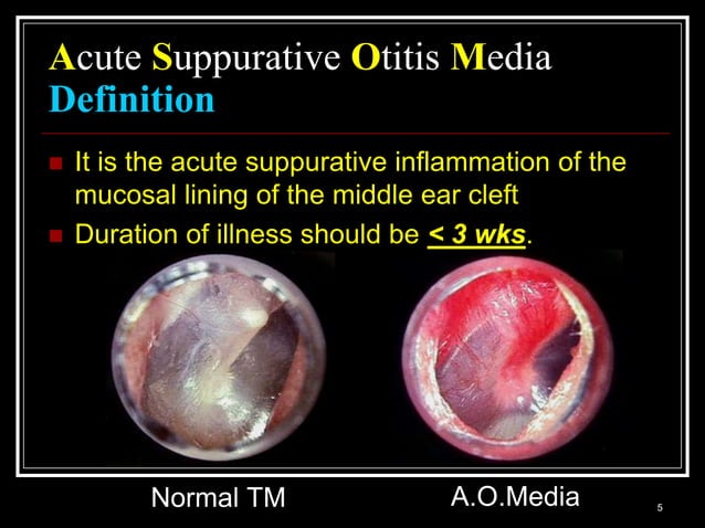 Acute otitis media (AOM) secretory otitis media (OME)