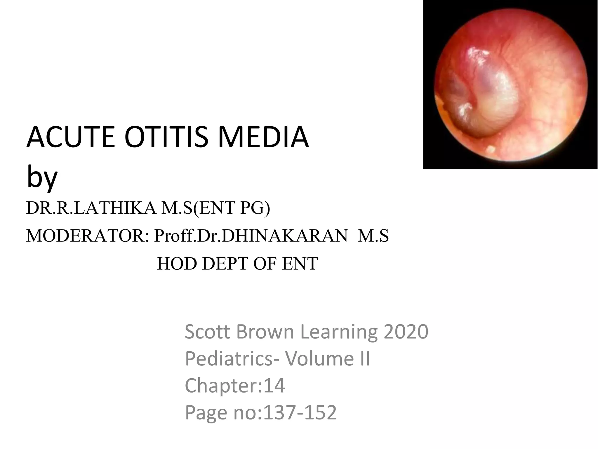 Acute otitis media final | PPTX