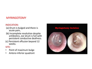 Acute otitis media | PPTX